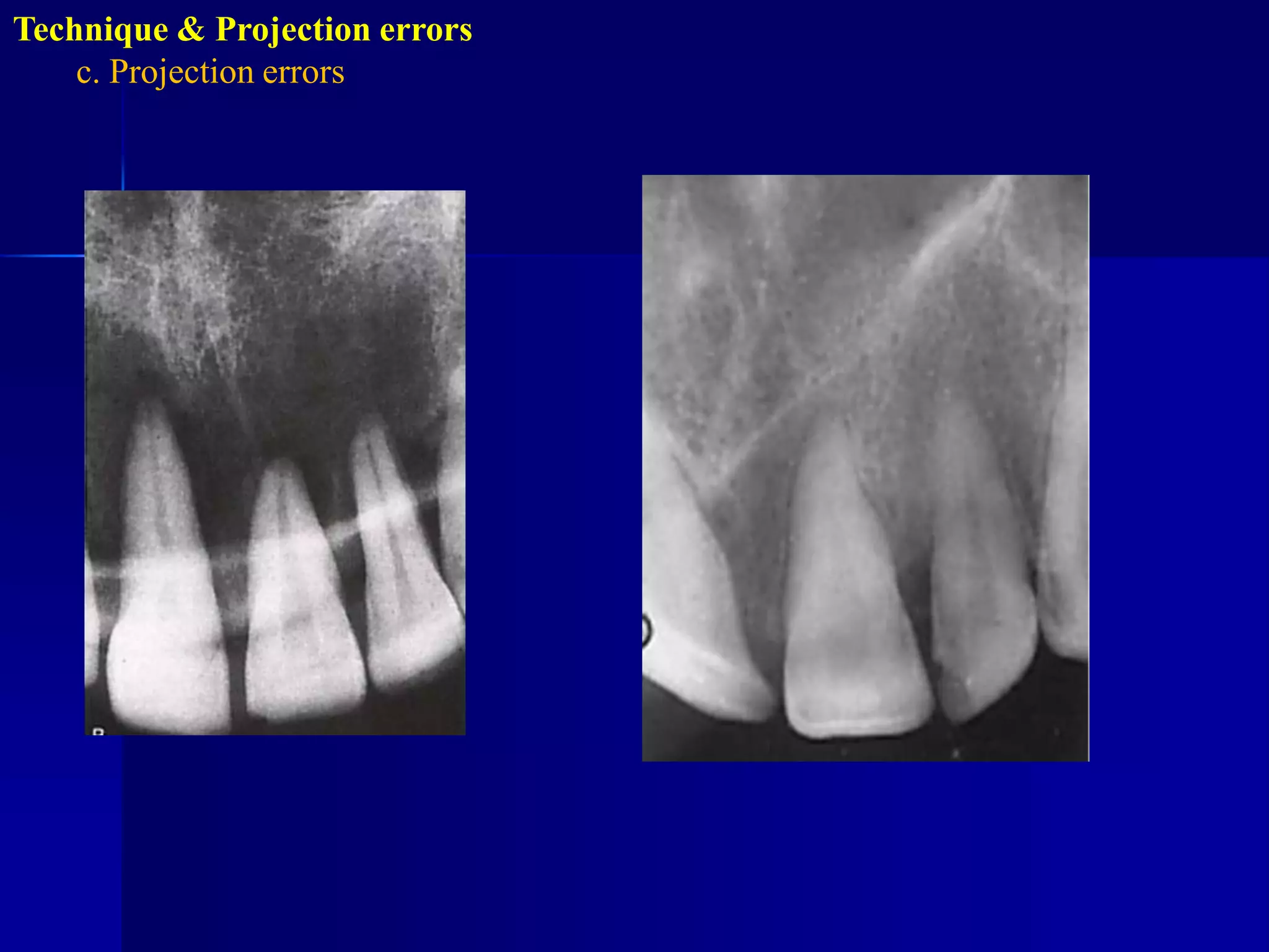 Radiographic errors and artifacts | PPTX