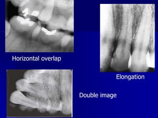 Radiographic In Dental Radiography Errors
