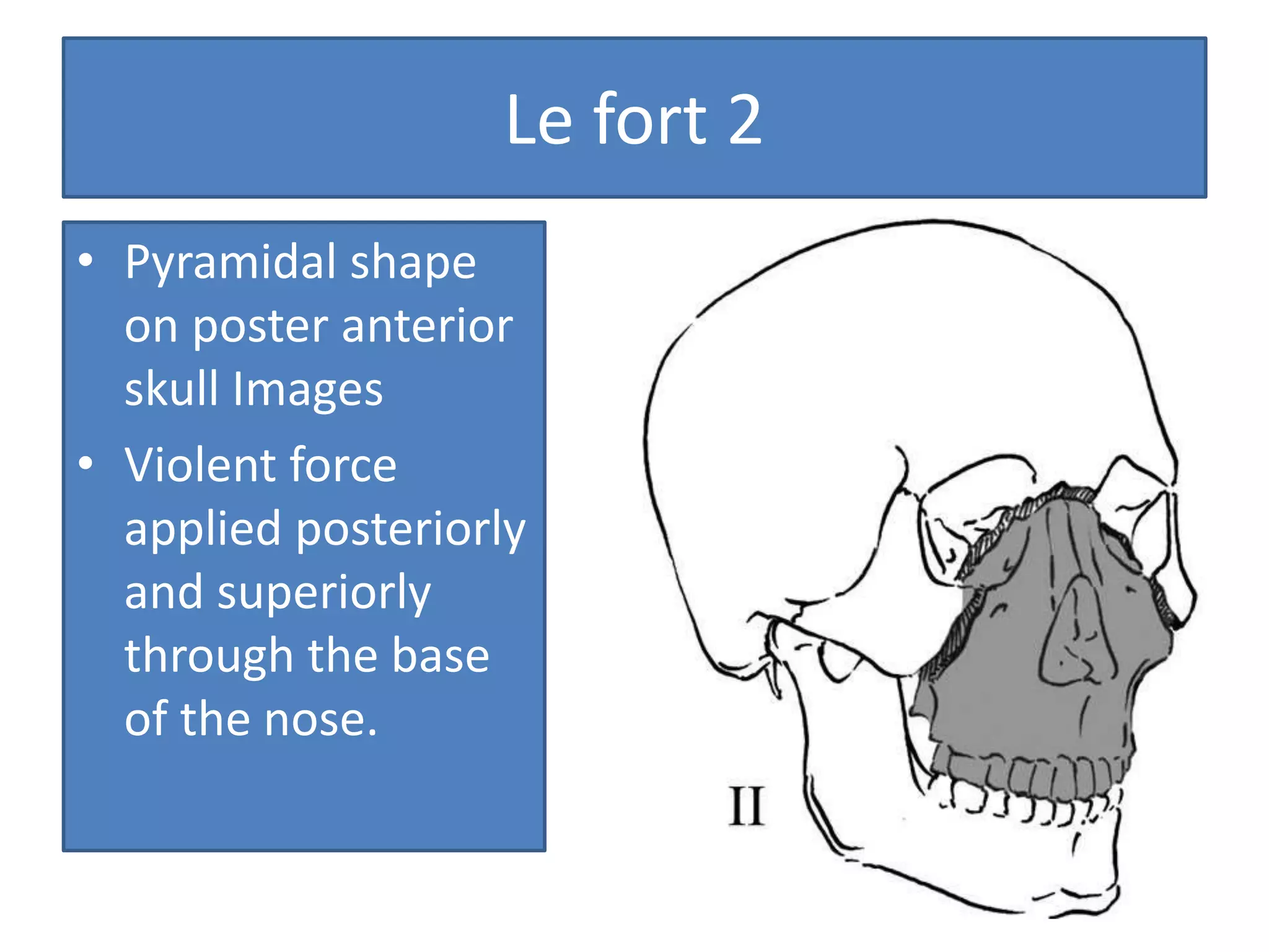 Radiographic evaluation of midface fracture | PPTX