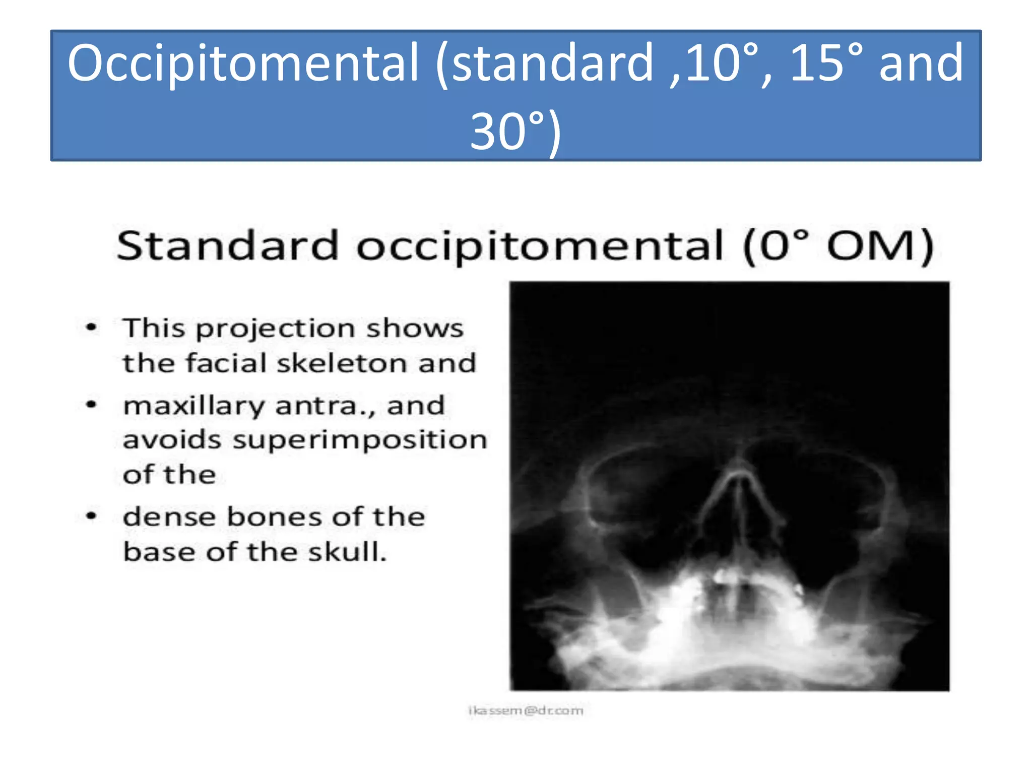 Radiographic evaluation of midface fracture | PPTX