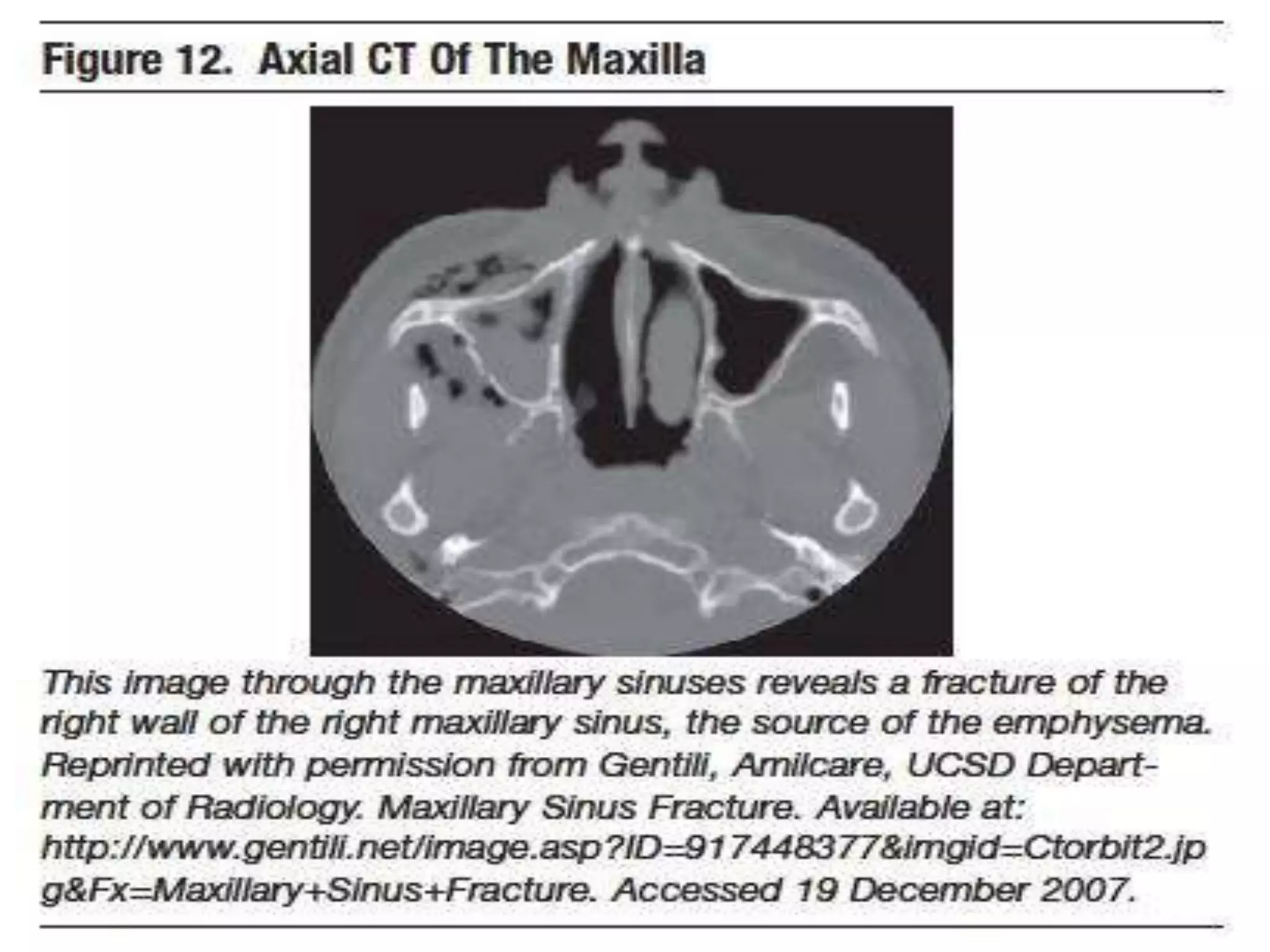 Radiographic evaluation of midface fracture | PPTX