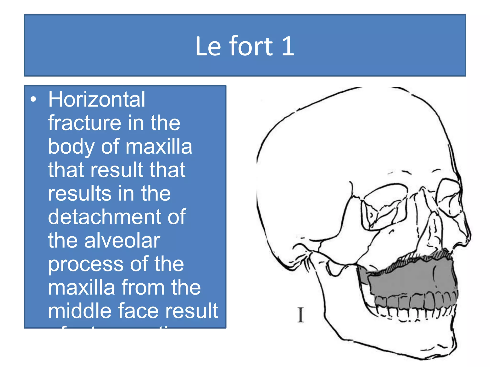 Radiographic evaluation of midface fracture | PPTX