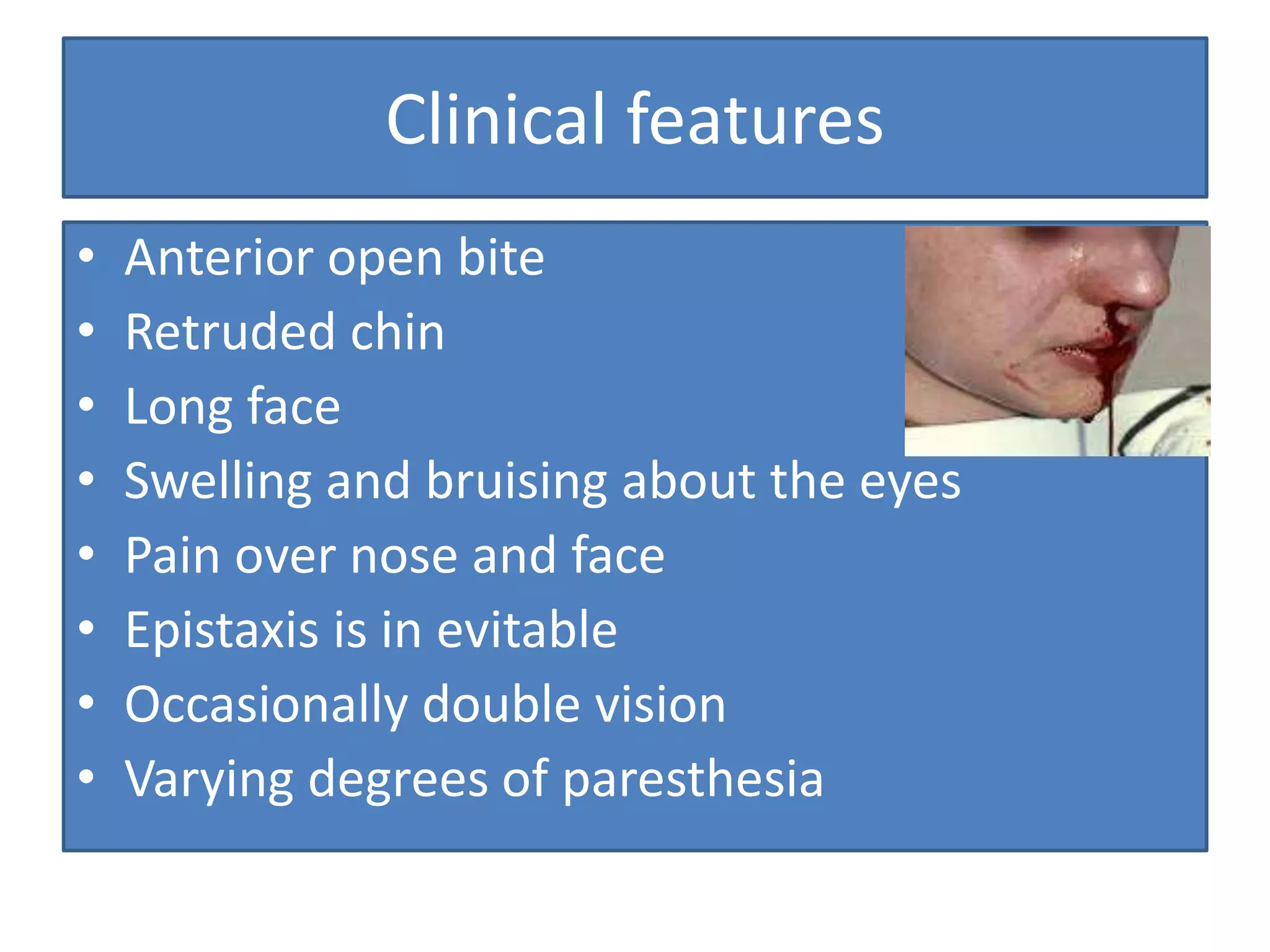 Radiographic evaluation of midface fracture | PPTX