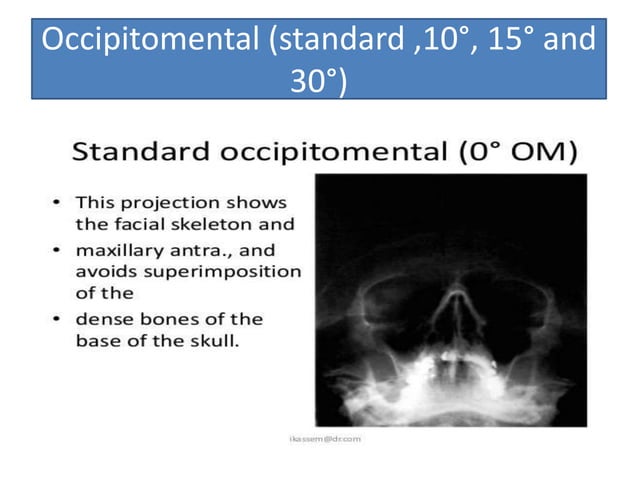 Radiographic evaluation of midface fracture | PPTX | Death, Injury, or ...