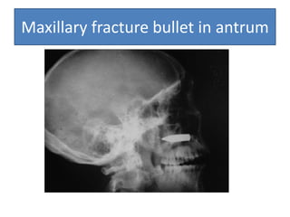 Radiographic evaluation of midface fracture | PPTX
