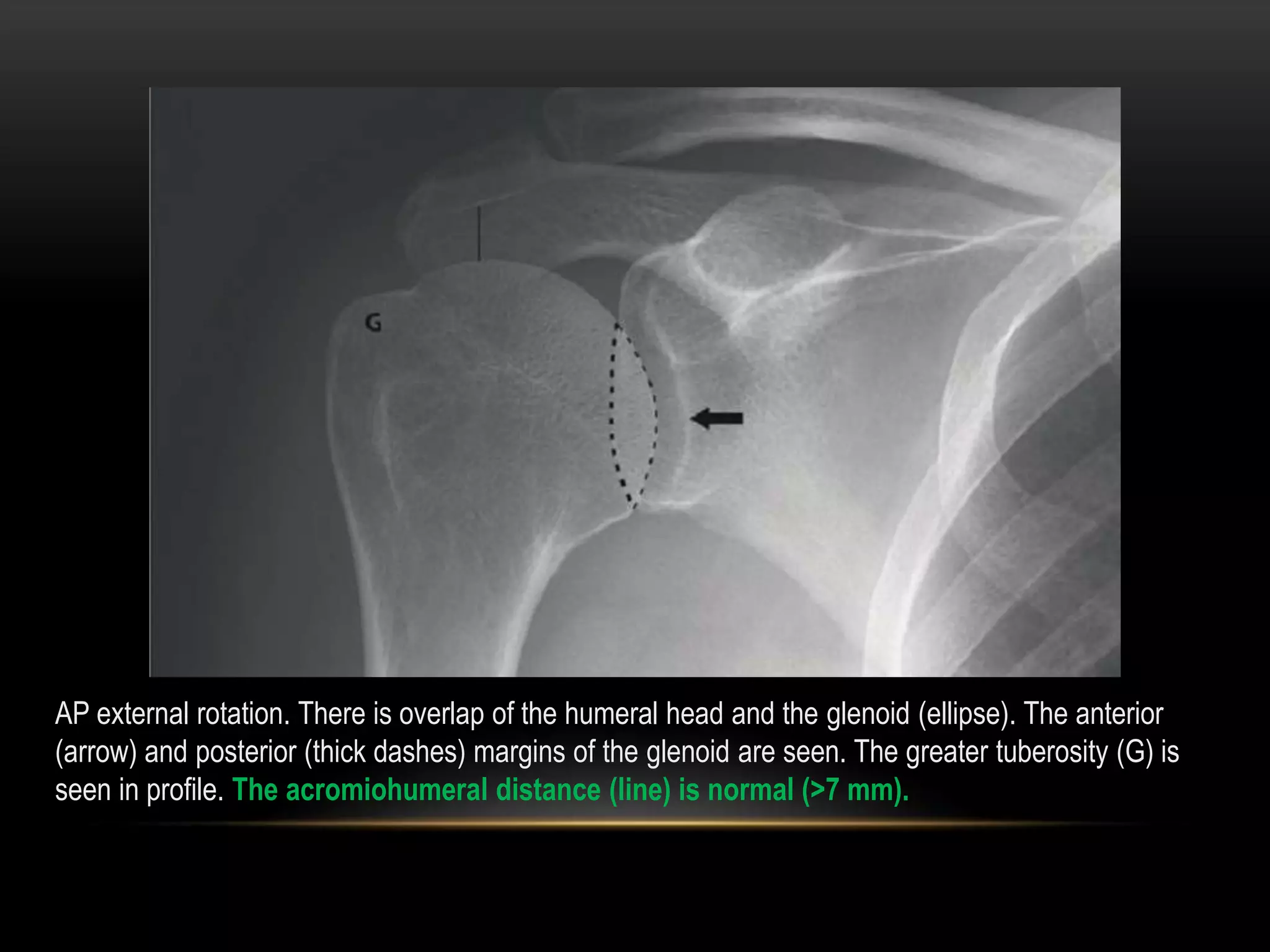 Radiographic evaluation of shoulder | PPTX
