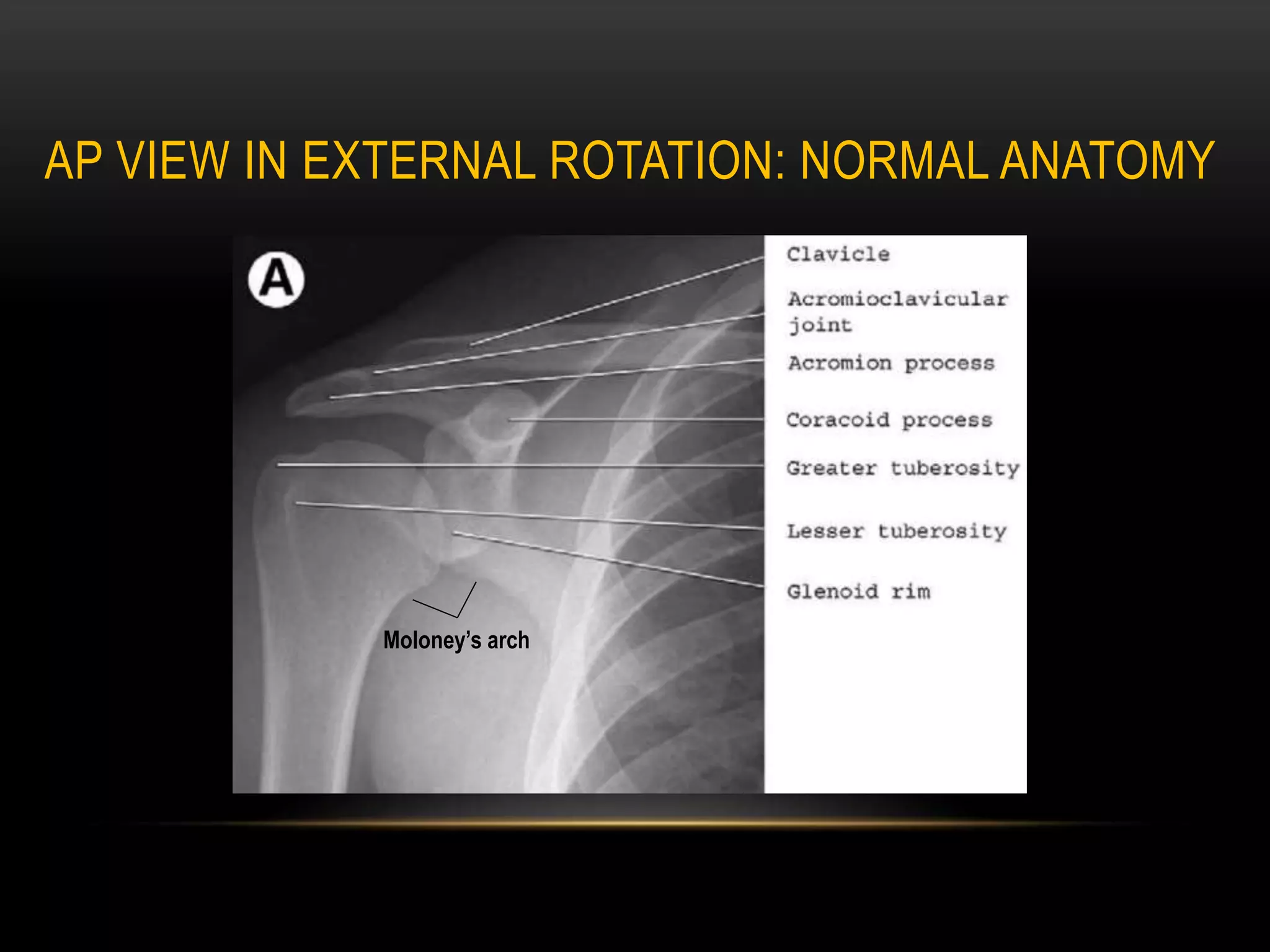 Radiographic evaluation of shoulder | PPTX