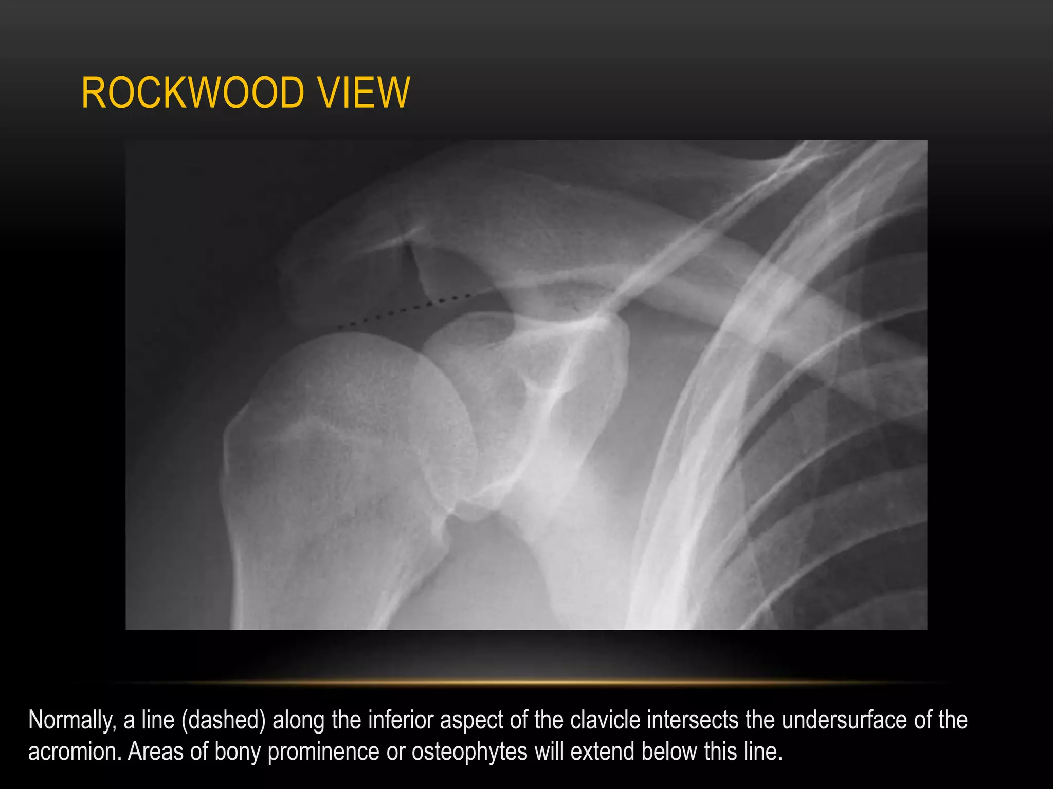 Radiographic evaluation of shoulder | PPTX