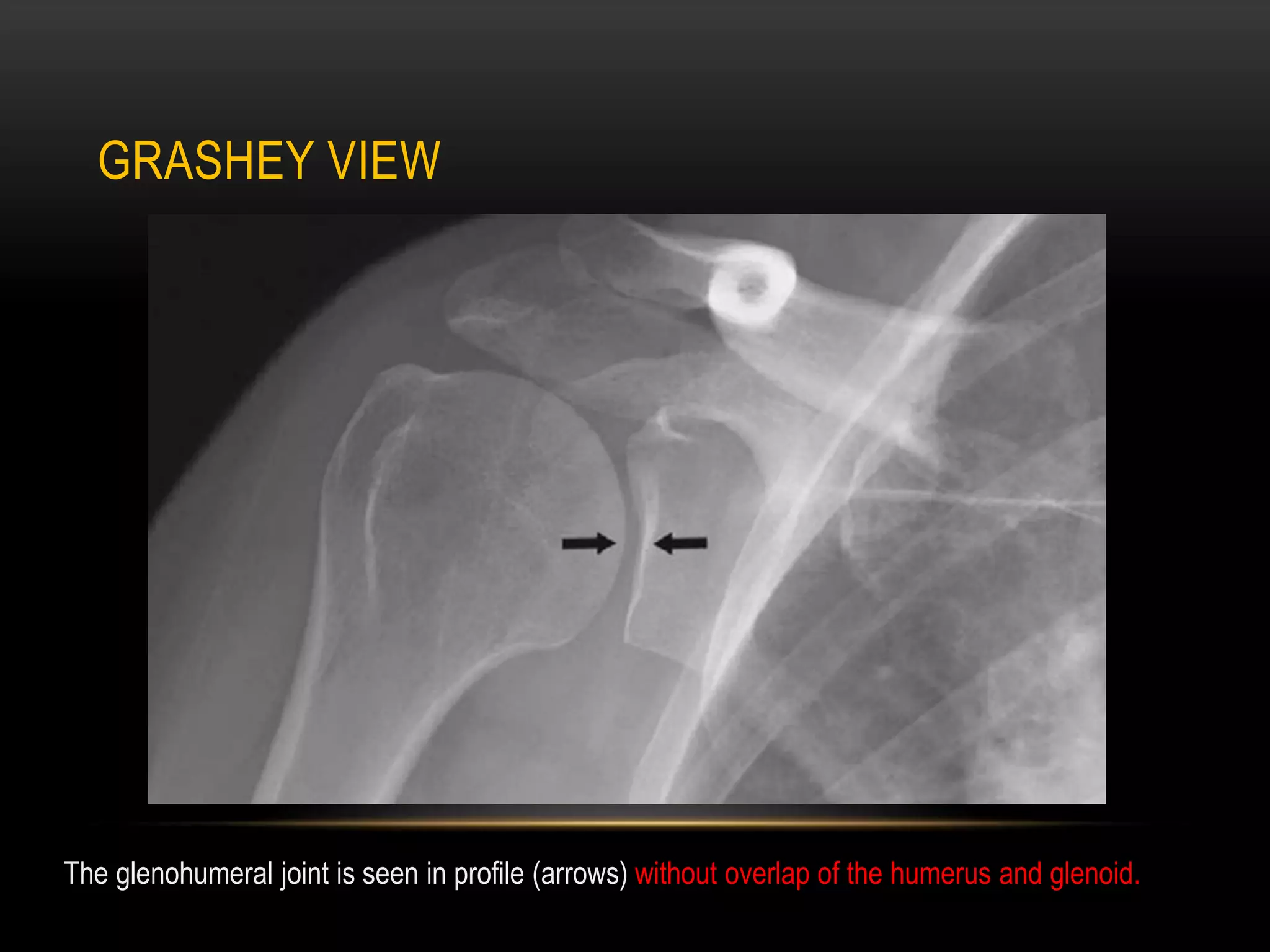 Radiographic evaluation of shoulder | PPTX