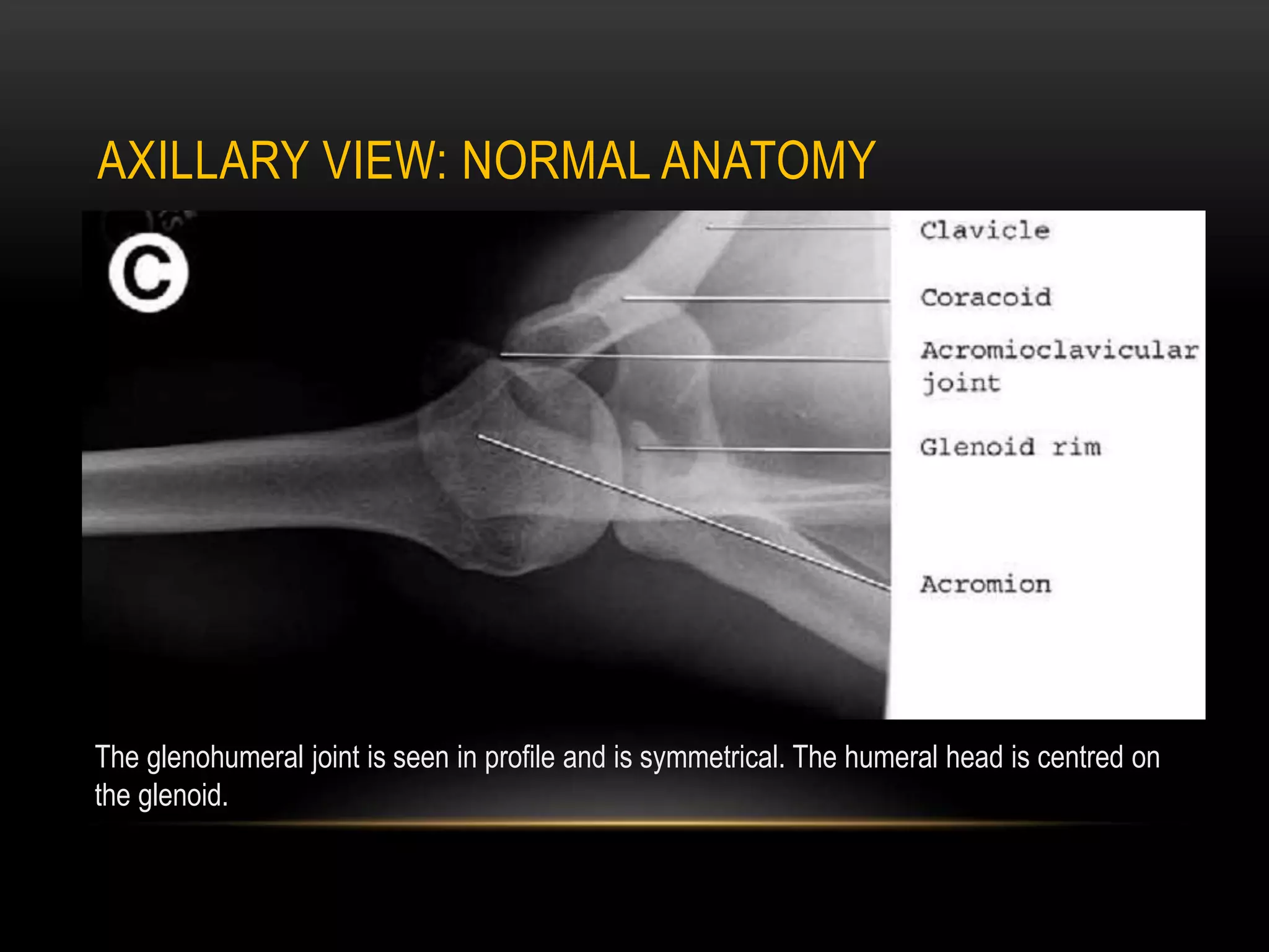 Radiographic evaluation of shoulder | PPTX