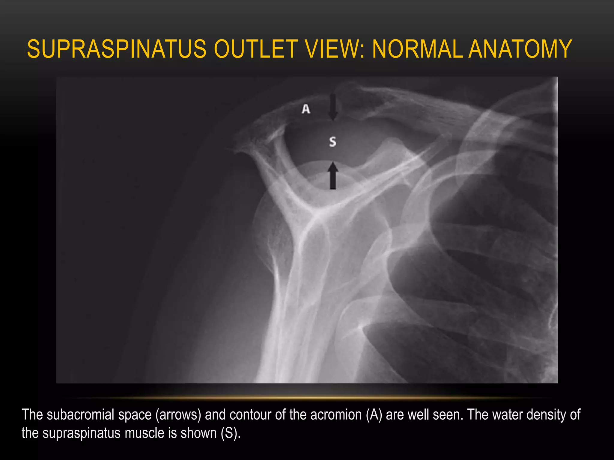 Radiographic evaluation of shoulder | PPTX