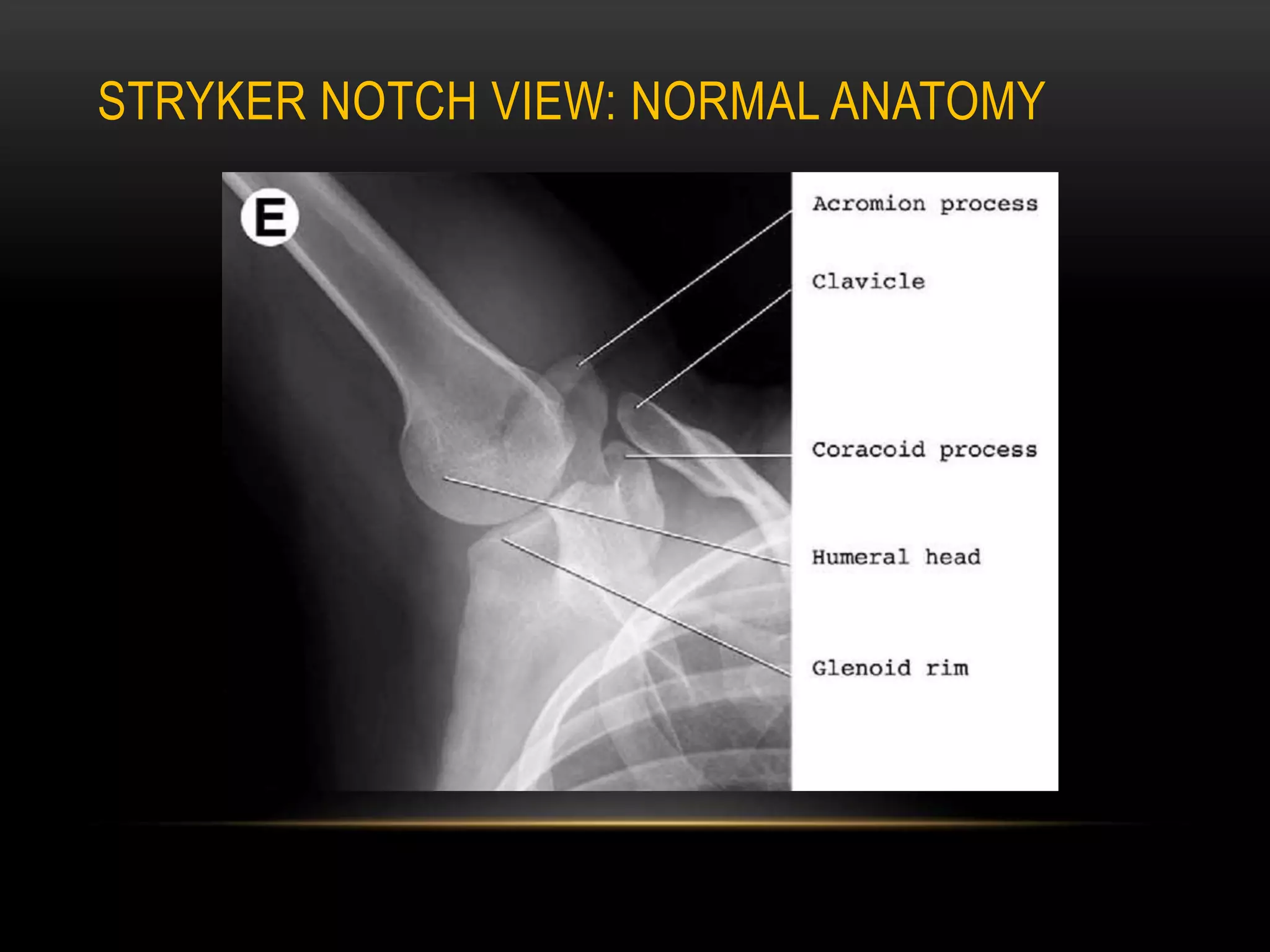 Radiographic evaluation of shoulder | PPTX