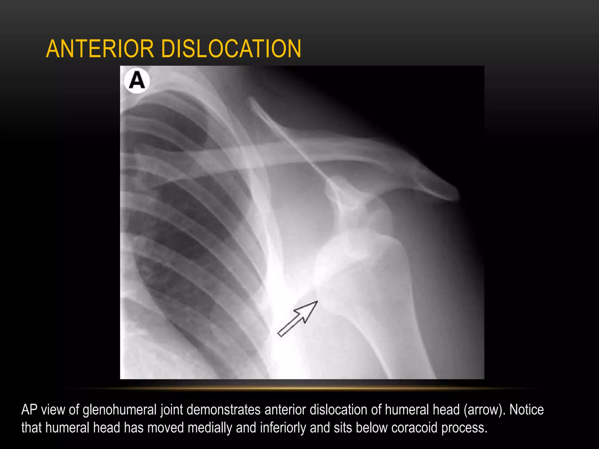 Radiographic evaluation of shoulder | PPTX