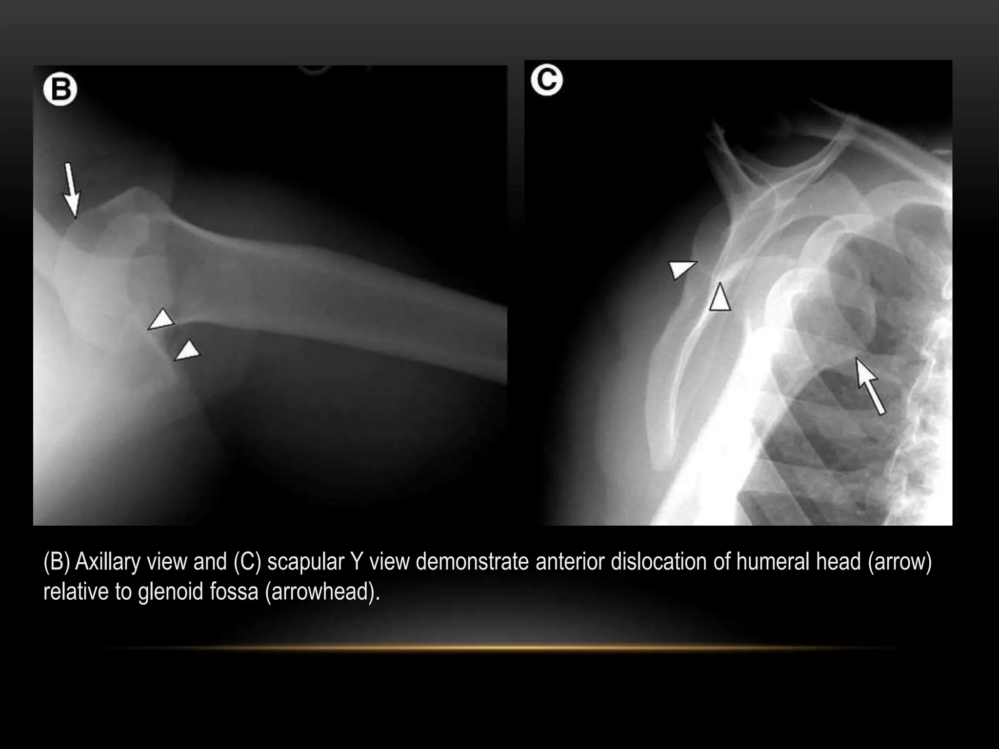 Radiographic evaluation of shoulder | PPTX