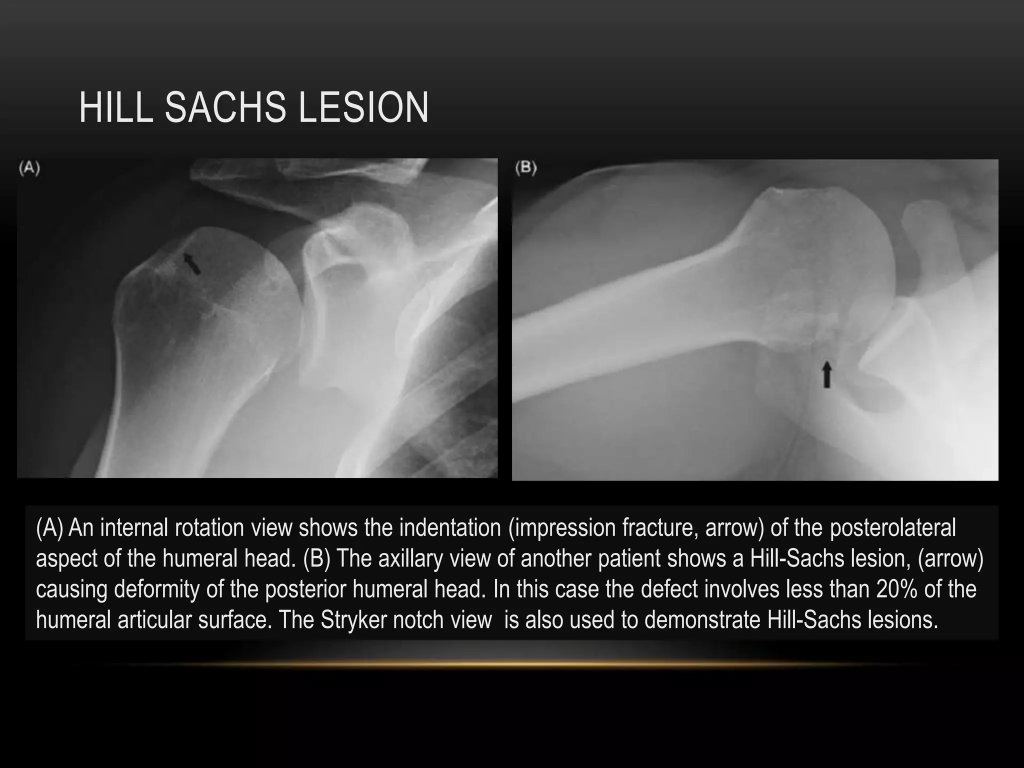 Radiographic evaluation of shoulder | PPTX