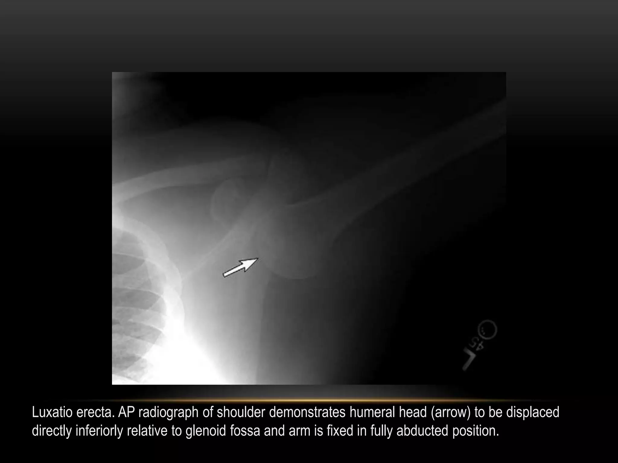 Radiographic evaluation of shoulder | PPTX