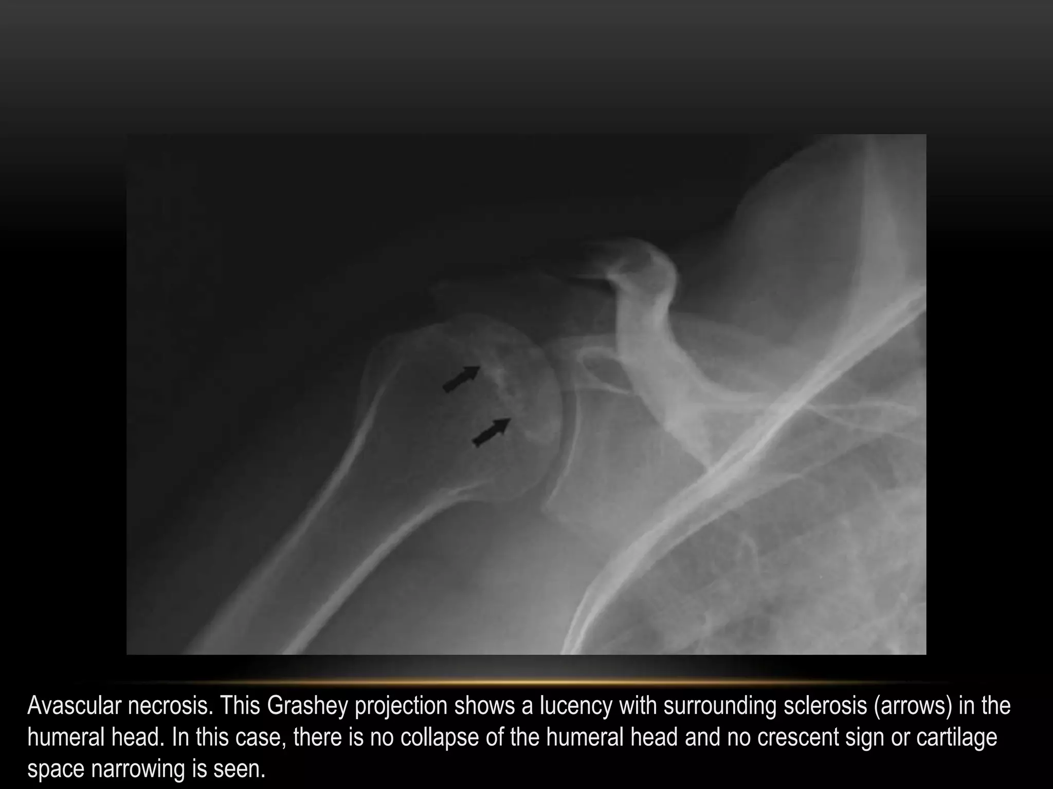 Radiographic evaluation of shoulder | PPTX
