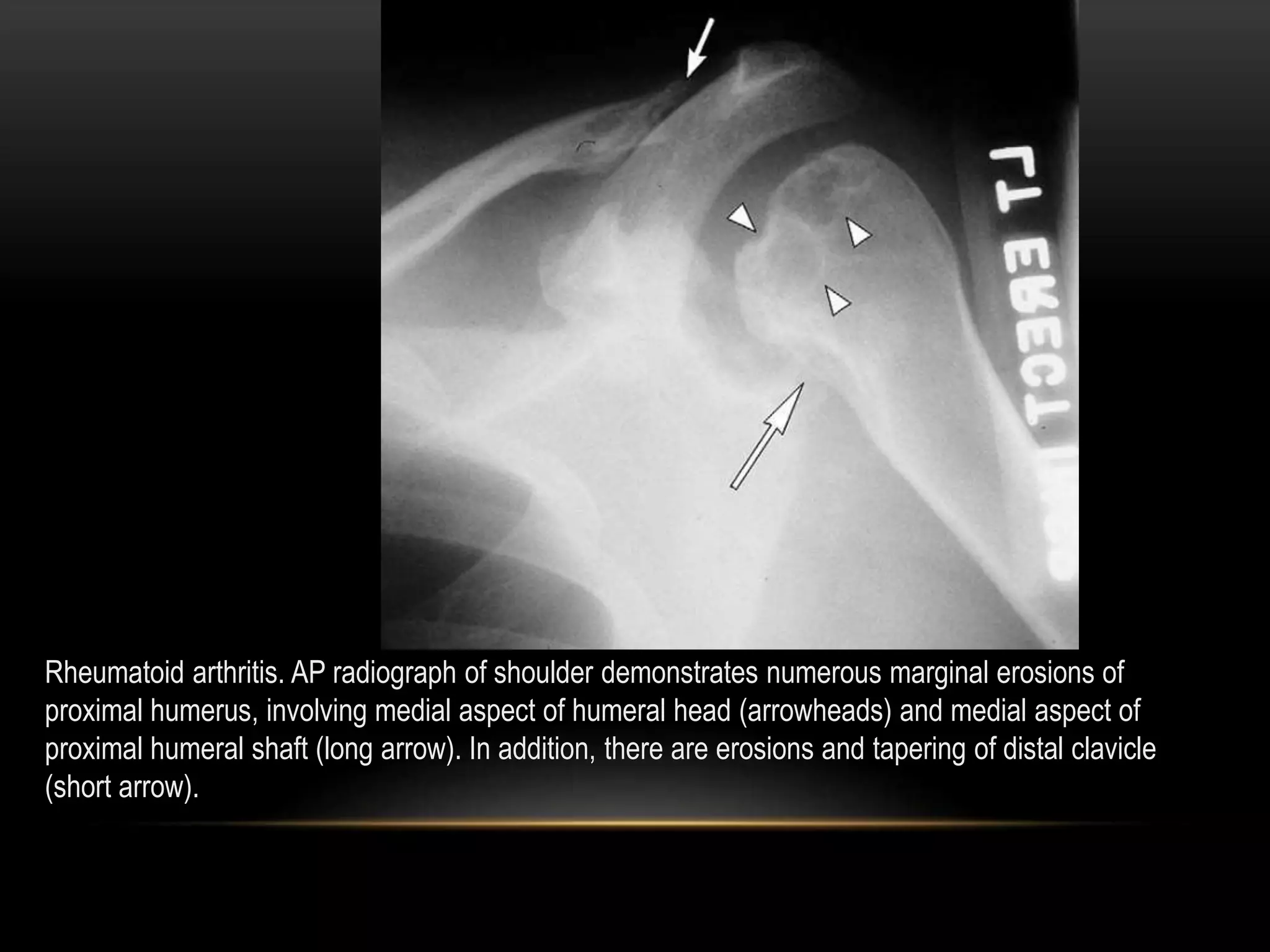 Radiographic evaluation of shoulder | PPTX