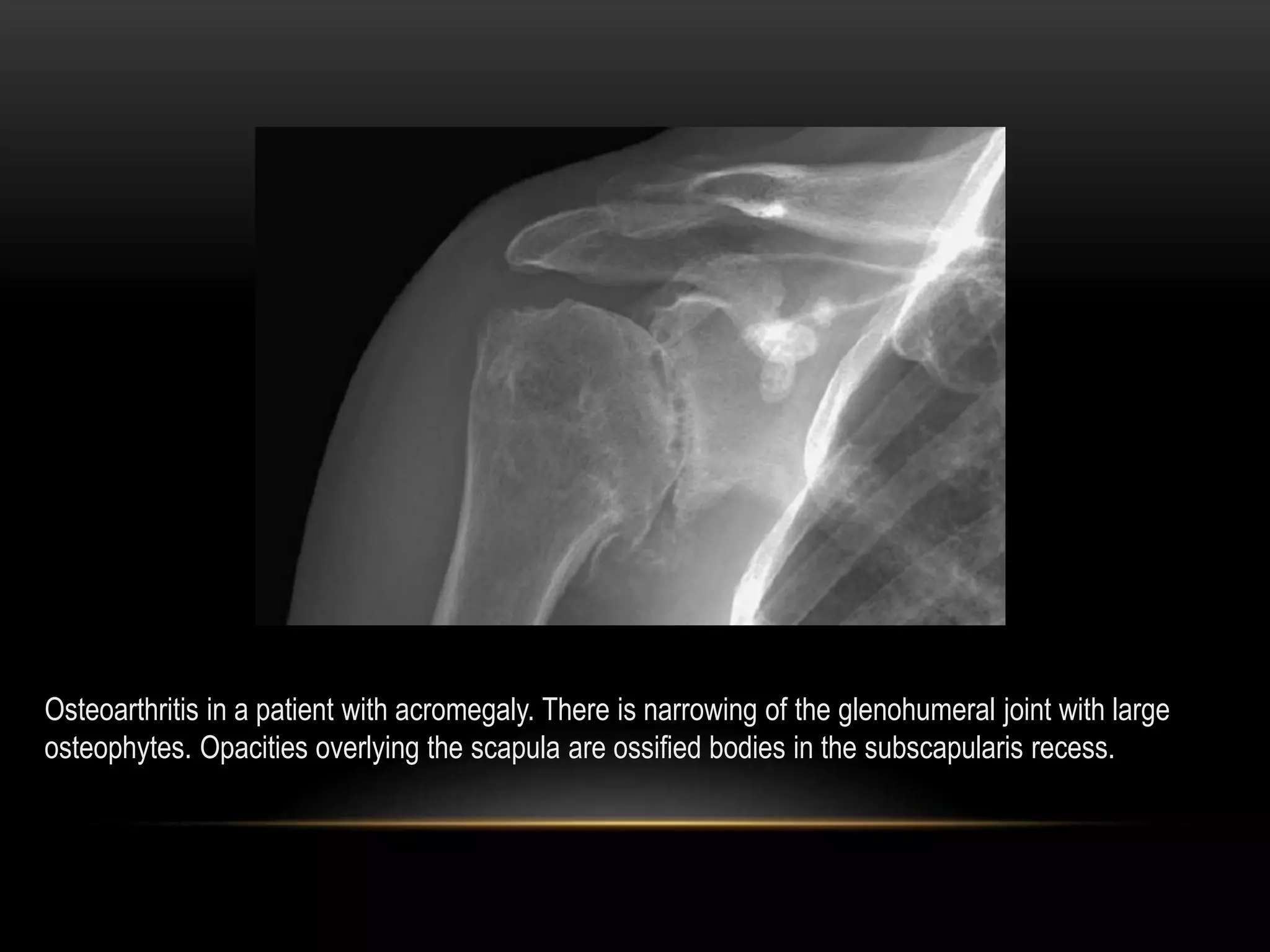 Radiographic evaluation of shoulder | PPTX