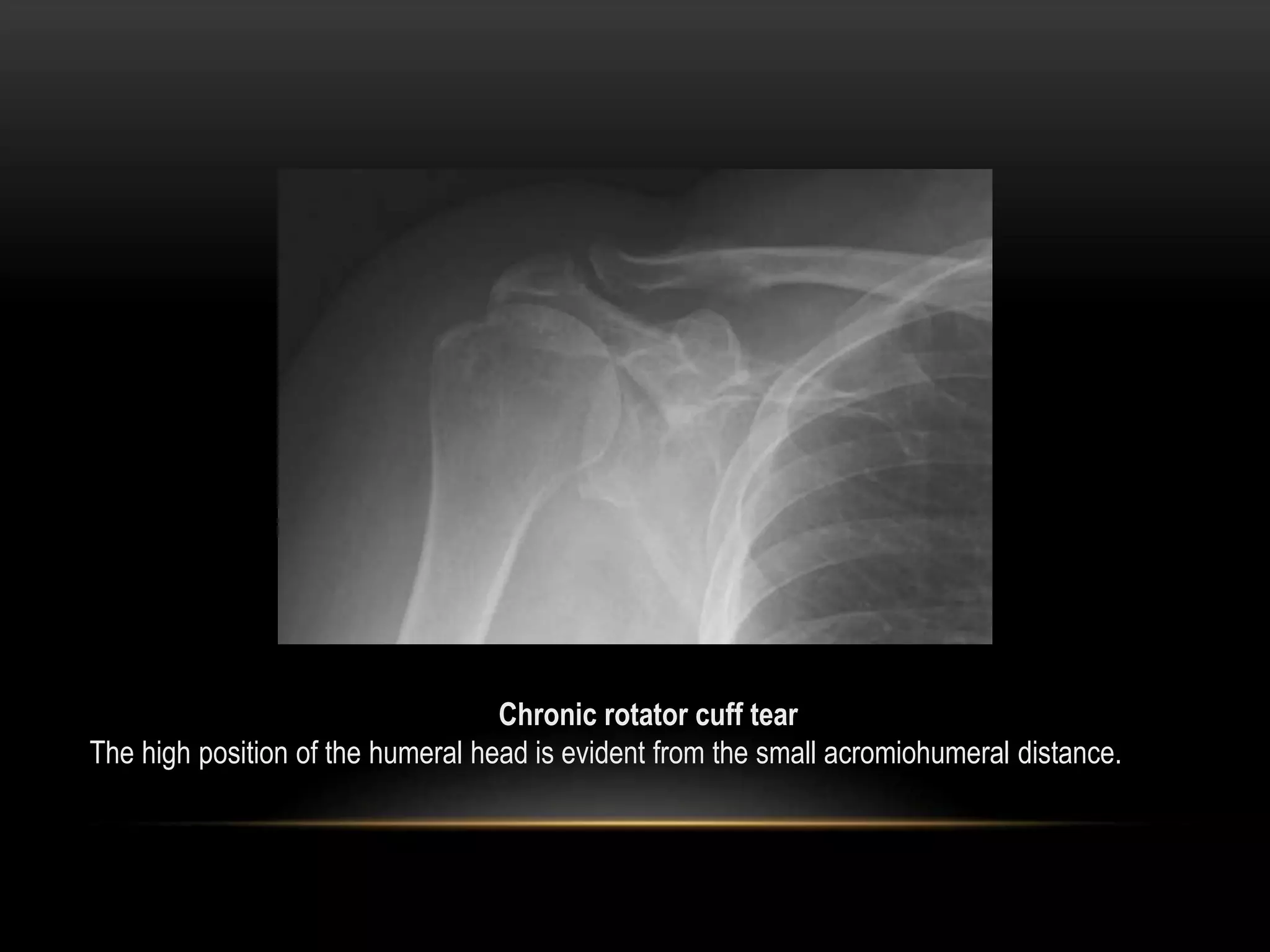 Radiographic evaluation of shoulder | PPTX