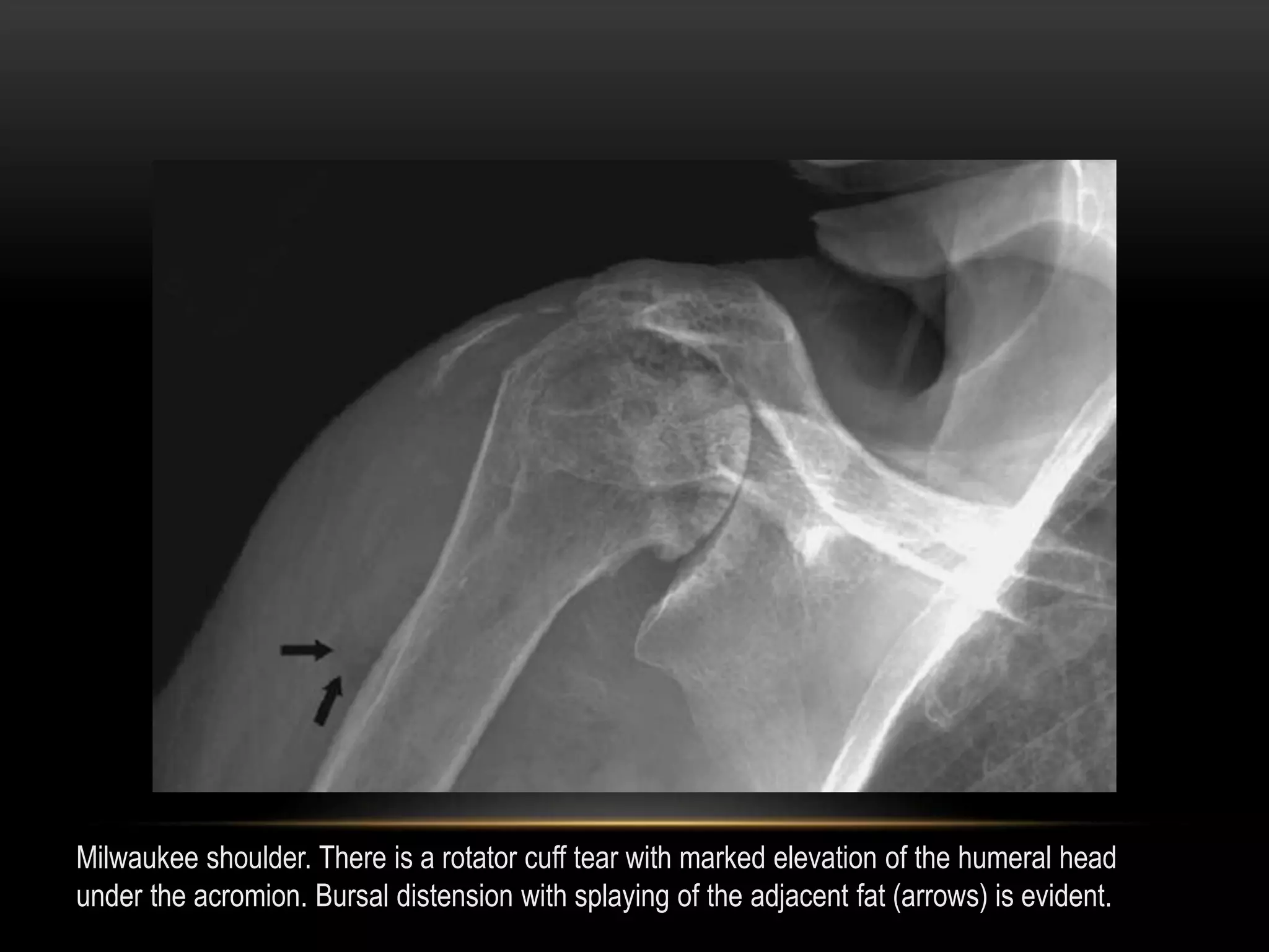 Radiographic evaluation of shoulder | PPTX