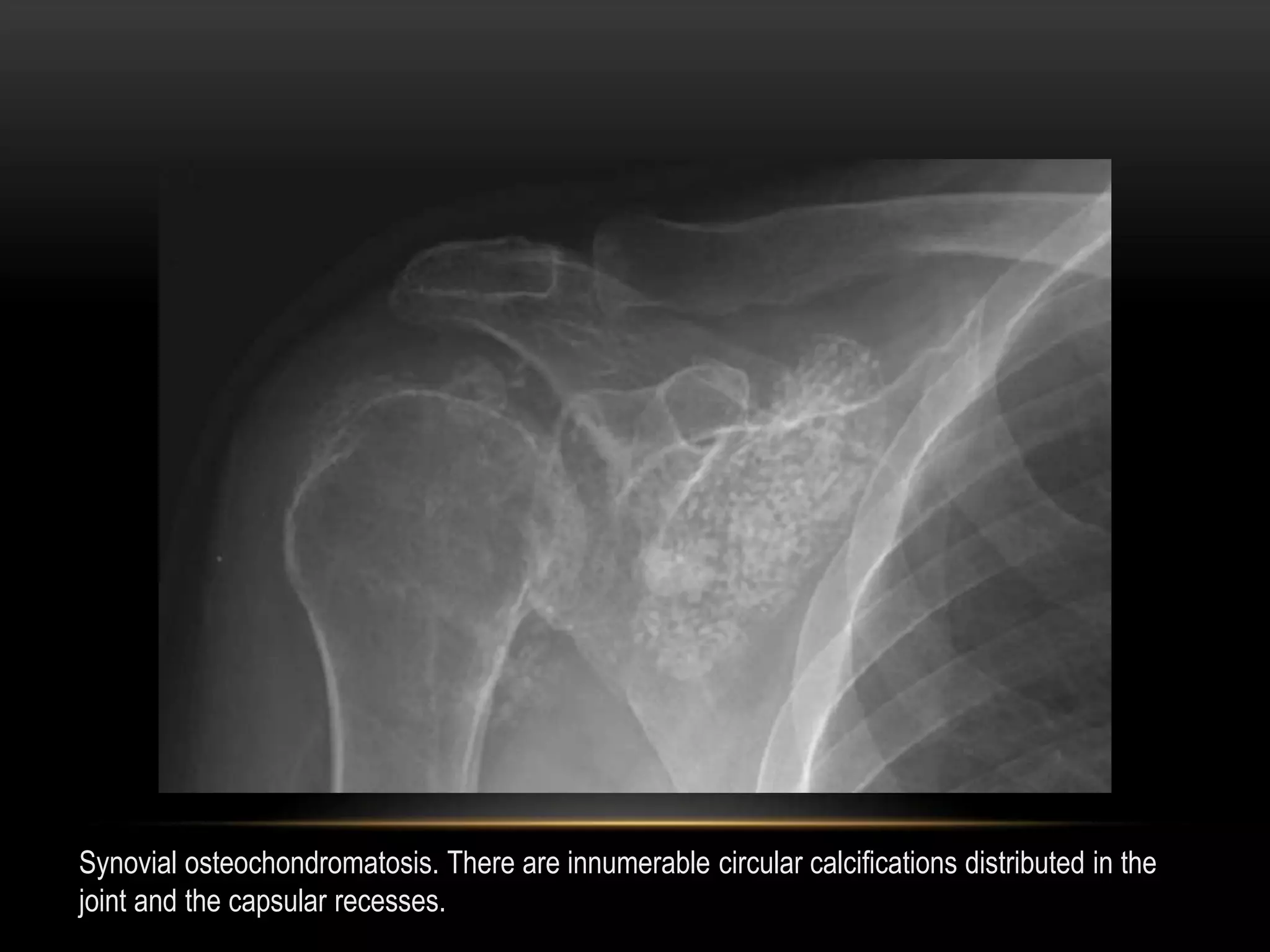Radiographic evaluation of shoulder | PPTX
