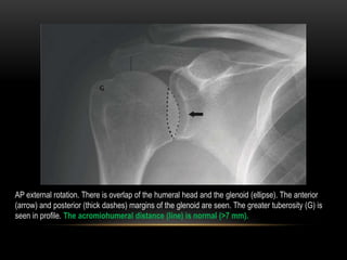 Radiographic evaluation of shoulder | PPTX