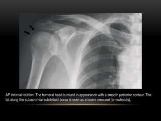 Radiographic evaluation of shoulder | PPTX