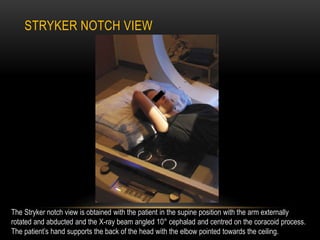 Radiographic evaluation of shoulder | PPTX