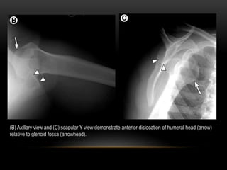 Radiographic evaluation of shoulder | PPTX