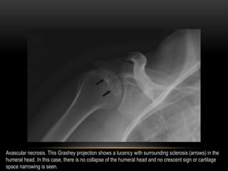 Radiographic evaluation of shoulder | PPTX