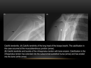 Radiographic evaluation of shoulder | PPTX