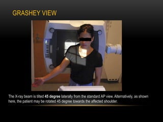 Radiographic evaluation of shoulder | PPT