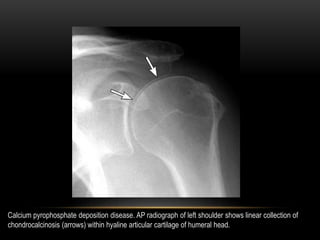 Chondrocalcinosis Shoulder