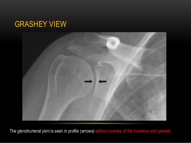Radiographic evaluation of shoulder