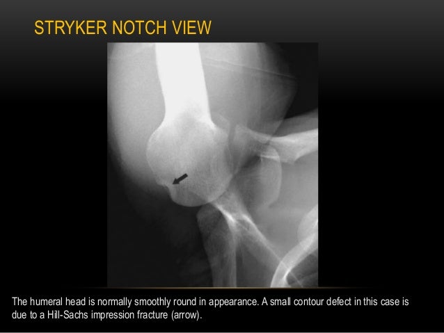 Radiographic evaluation of shoulder