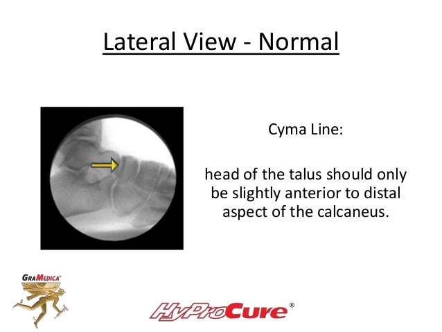 Radiographic Evidence of TaloTarsal Dislocation