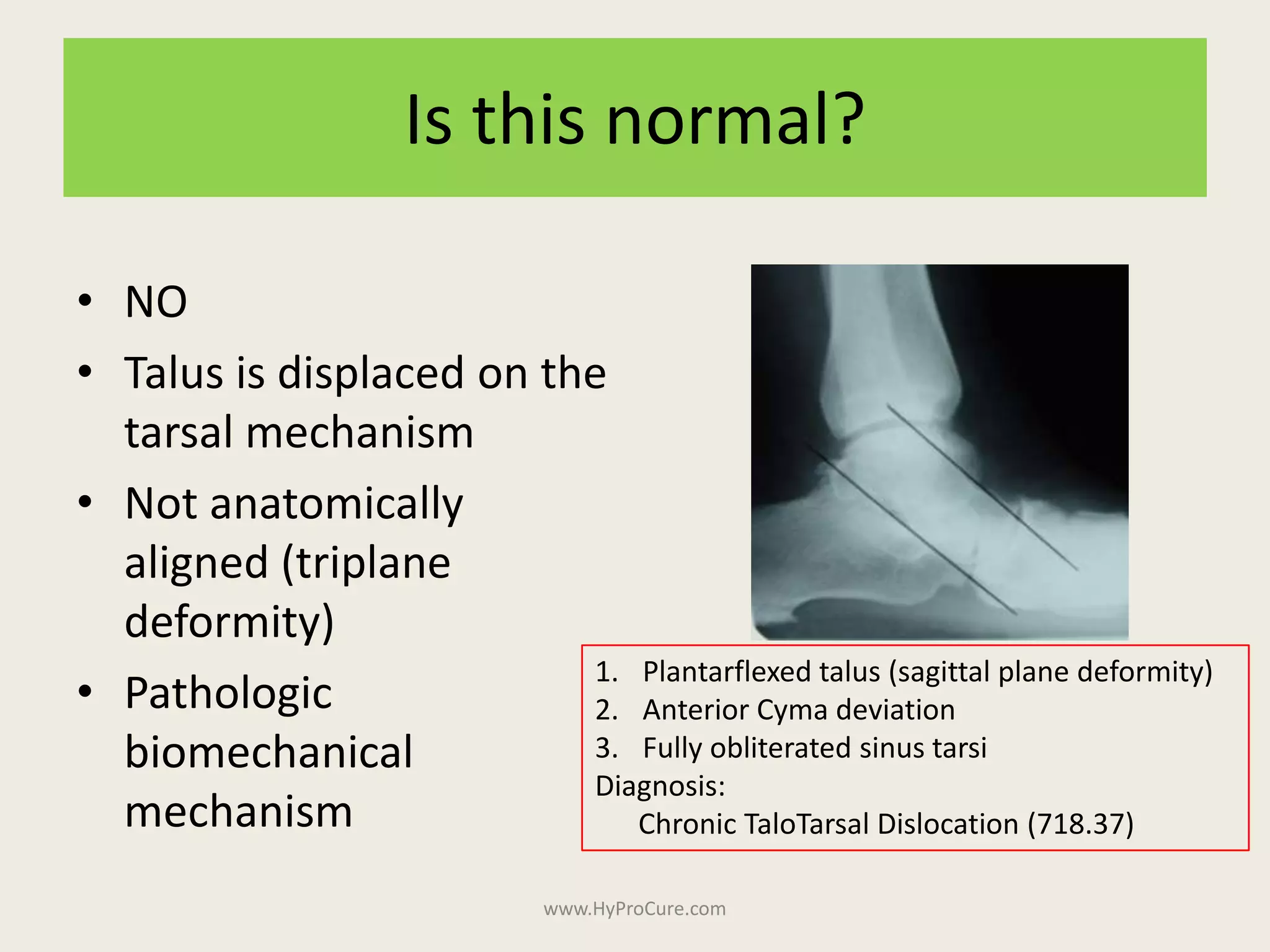 TaloTarsal Dislocation - Radiographic Evidence | PPTX