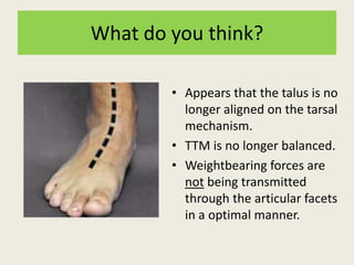 TaloTarsal Dislocation - Radiographic Evidence | PPTX