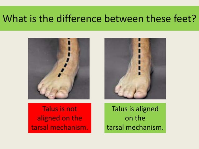 TaloTarsal Dislocation - Radiographic Evidence | PPTX