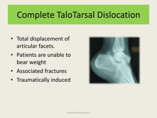 TaloTarsal Dislocation - Radiographic Evidence | PPTX