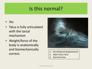 TaloTarsal Dislocation - Radiographic Evidence | PPTX