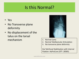TaloTarsal Dislocation - Radiographic Evidence | PPTX