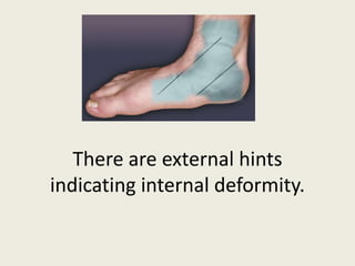 TaloTarsal Dislocation - Radiographic Evidence | PPTX