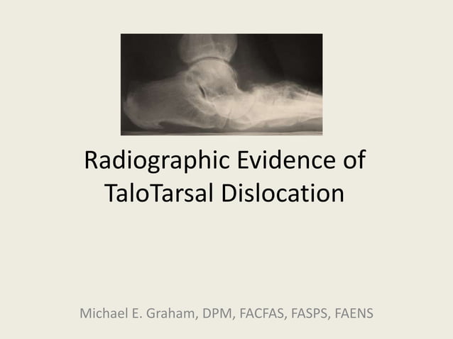 TaloTarsal Dislocation - Radiographic Evidence | PPTX
