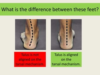 TaloTarsal Dislocation - Radiographic Evidence | PPT
