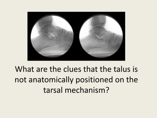 TaloTarsal Dislocation - Radiographic Evidence | PPT