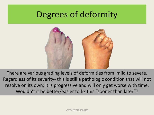 TaloTarsal Dislocation - Radiographic Evidence