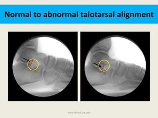 TaloTarsal Dislocation - Radiographic Evidence