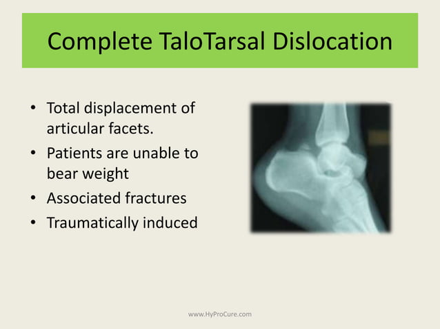 TaloTarsal Dislocation - Radiographic Evidence